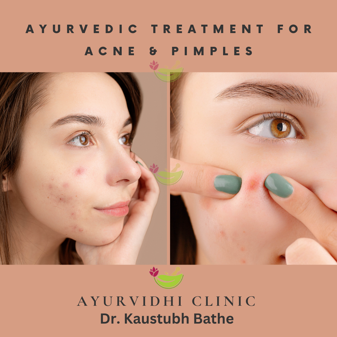 Unlock Clear Skin: Ayurvedic Secrets for Treating Acne Pimples ...
